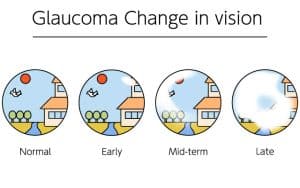 Glaucoma - Utah Eye Centers