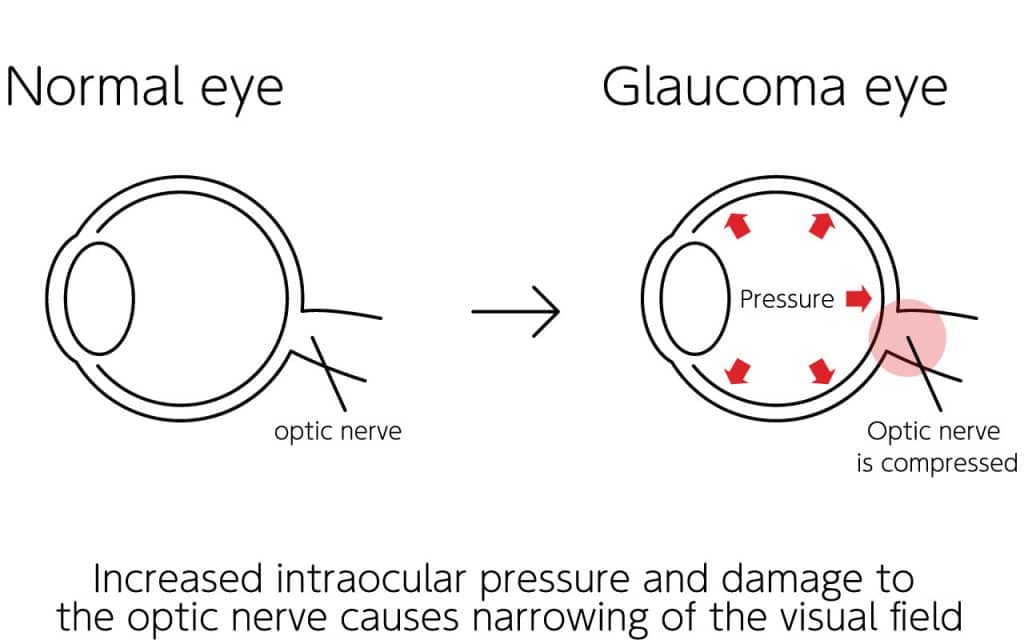 Glaucoma - Utah Eye Centers