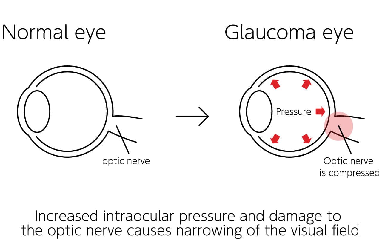 Glaucoma - Utah Eye Centers Glaucoma - Utah Eye Centers
